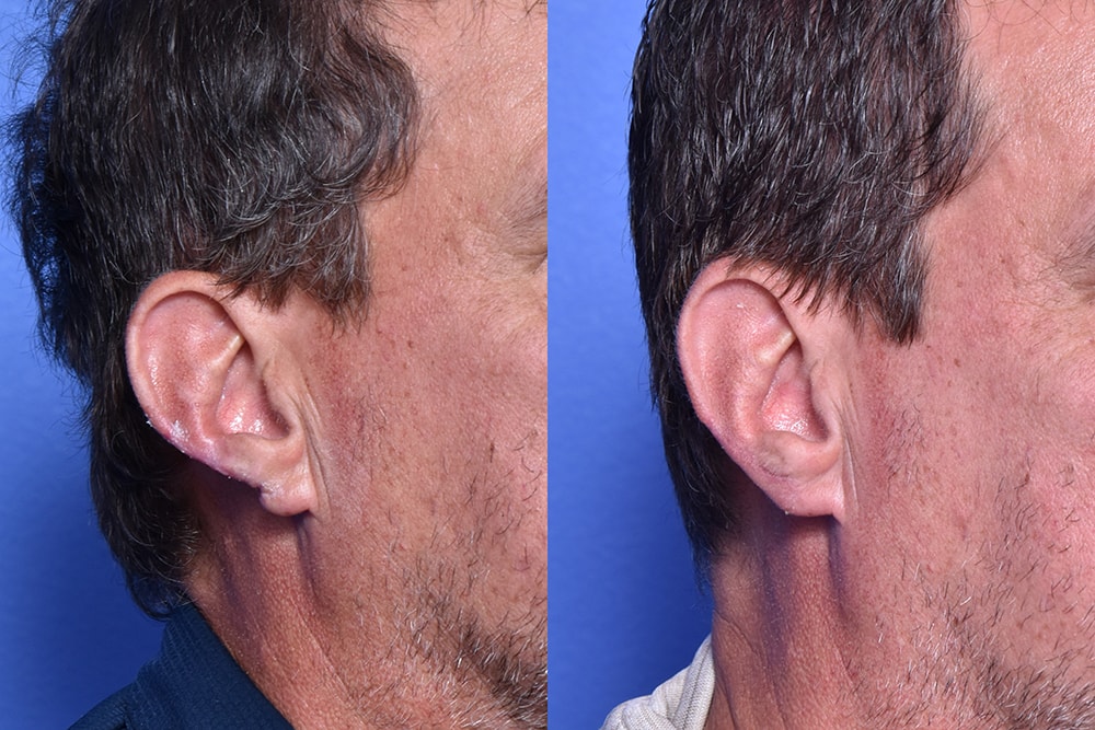 Earlobe Repair in Houston TX